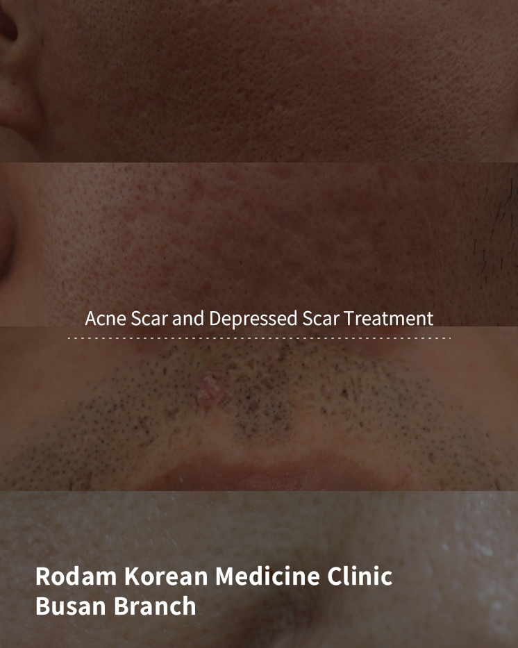 Rodam Korean Medicine Clinic Cheonan Branch, Acne Scar and Depressed ...